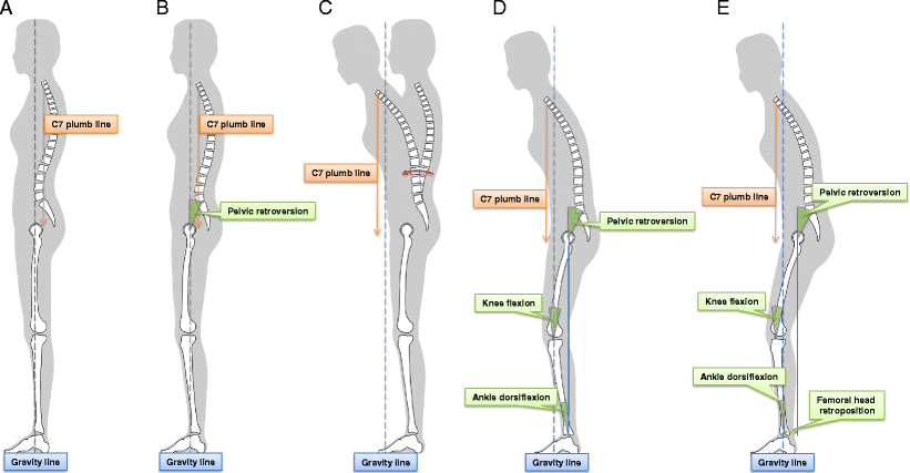 Femoral head retroposition as a potential compensatory mechanism in ...