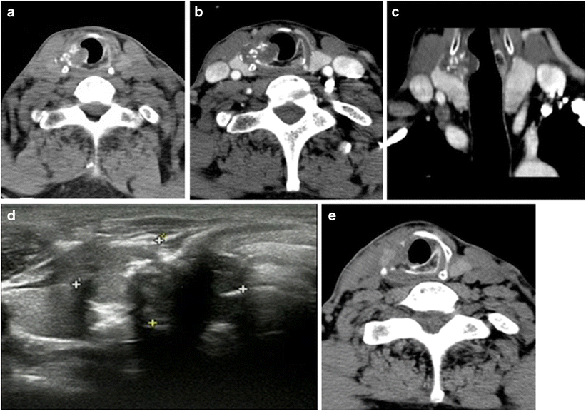 Low-grade chondrosarcoma of the cricoid cartilage: a case report and ...