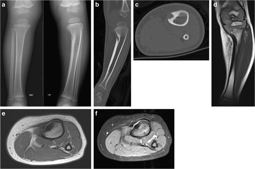 Abnormal alignment of the left lower extremity and irregular gait ...