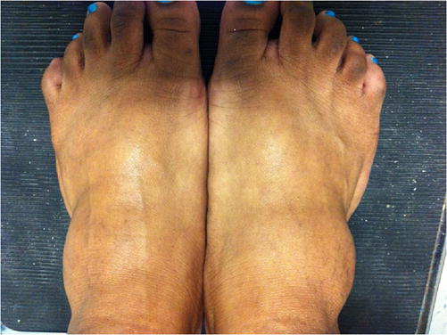 Bilateral painful foot masses | SpringerLink