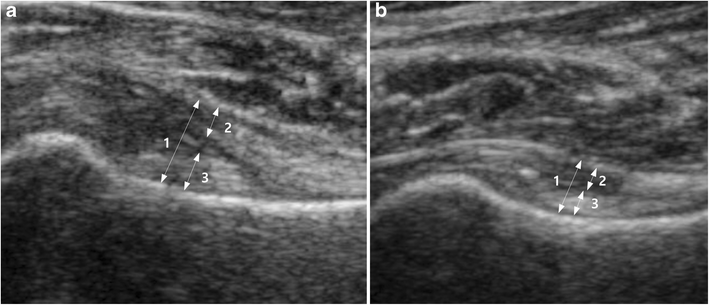 Ultrasound measurements of axillary recess capsule thickness in ...