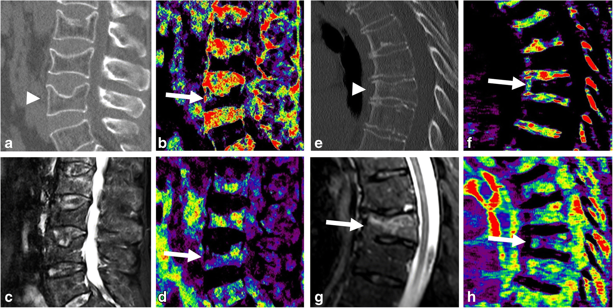 Three-material decomposition with dual-layer spectral CT compared to ...