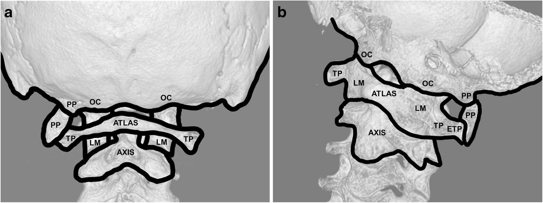Post-auricular lump: CT diagnosis | SpringerLink