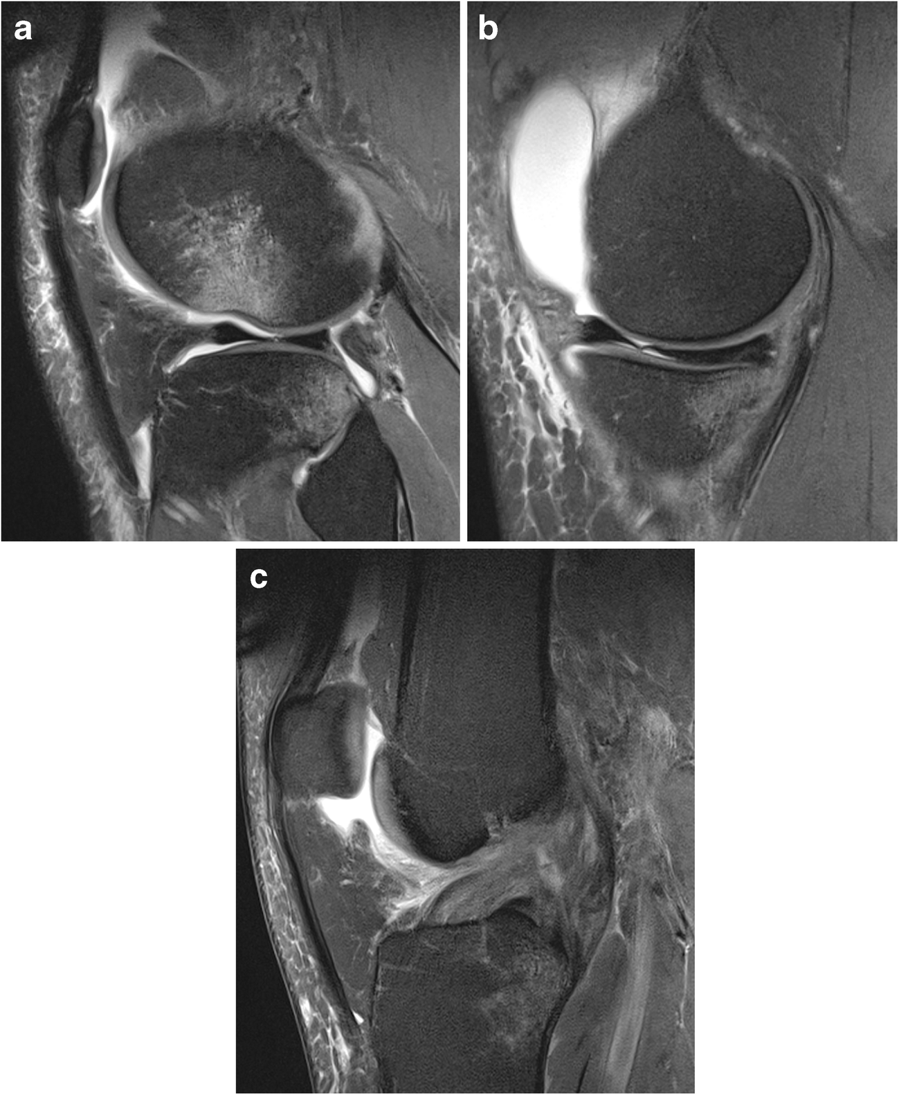 Magnetic resonance imaging appearances of the capsulo-osseous layer of ...