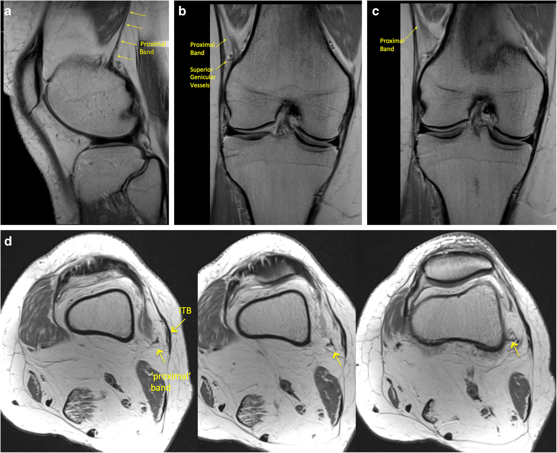 Magnetic resonance imaging appearances of the capsulo-osseous layer of ...