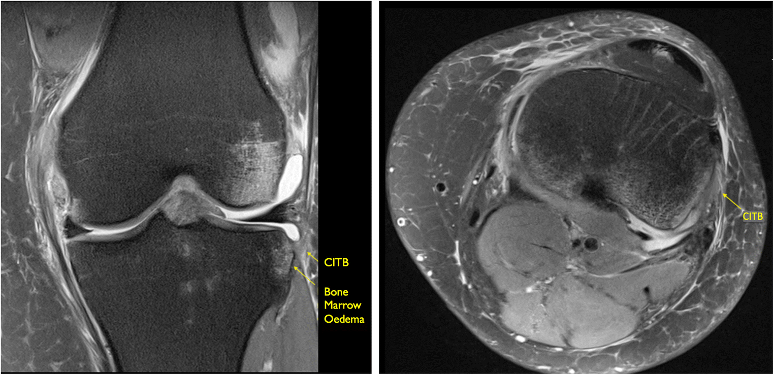 Magnetic resonance imaging appearances of the capsulo-osseous layer of ...