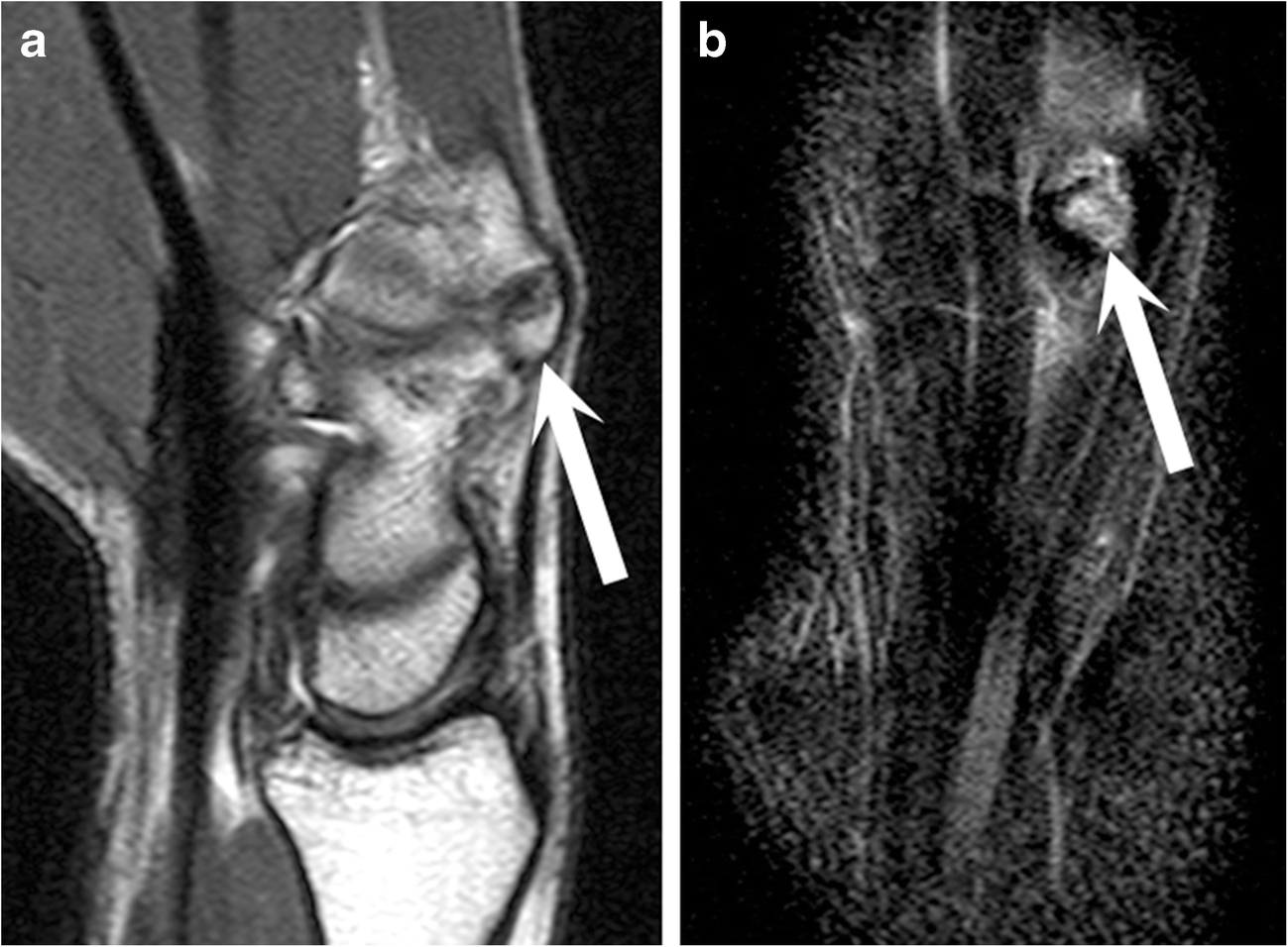 MRI of a painful carpal boss: variations at the extensor carpi radialis ...