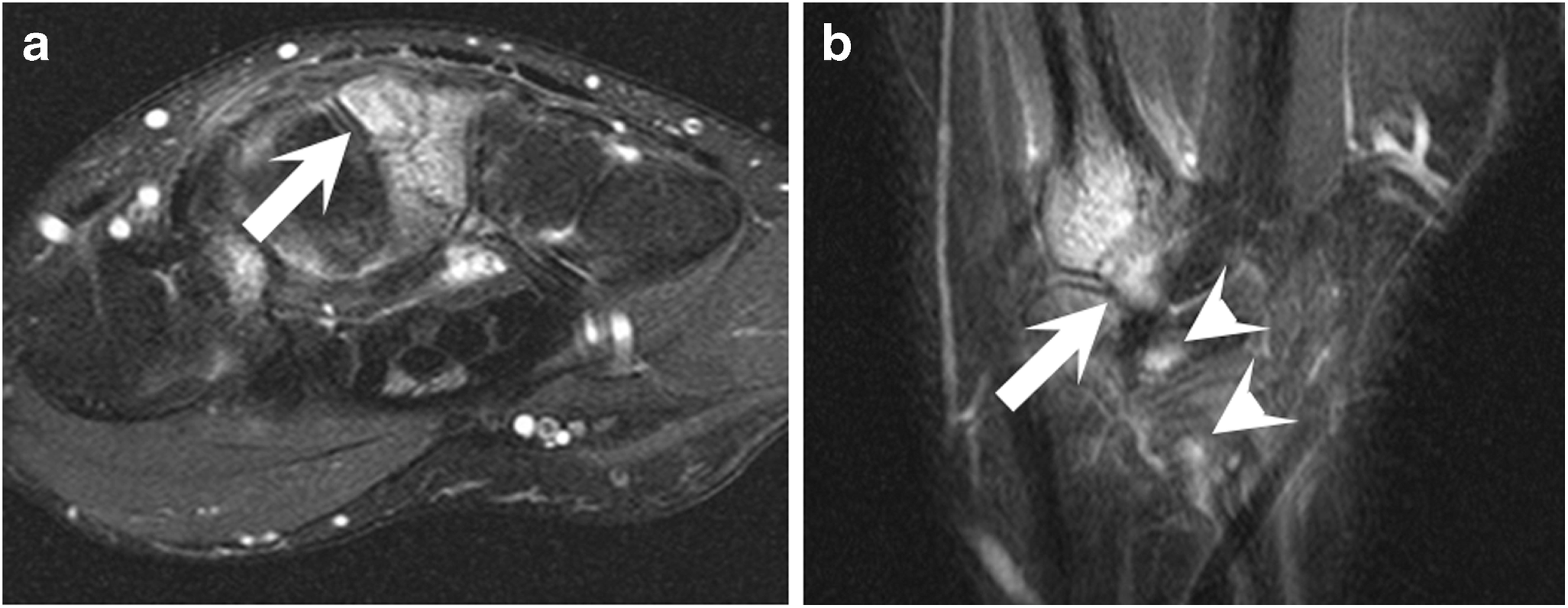 MRI of a painful carpal boss: variations at the extensor carpi radialis ...