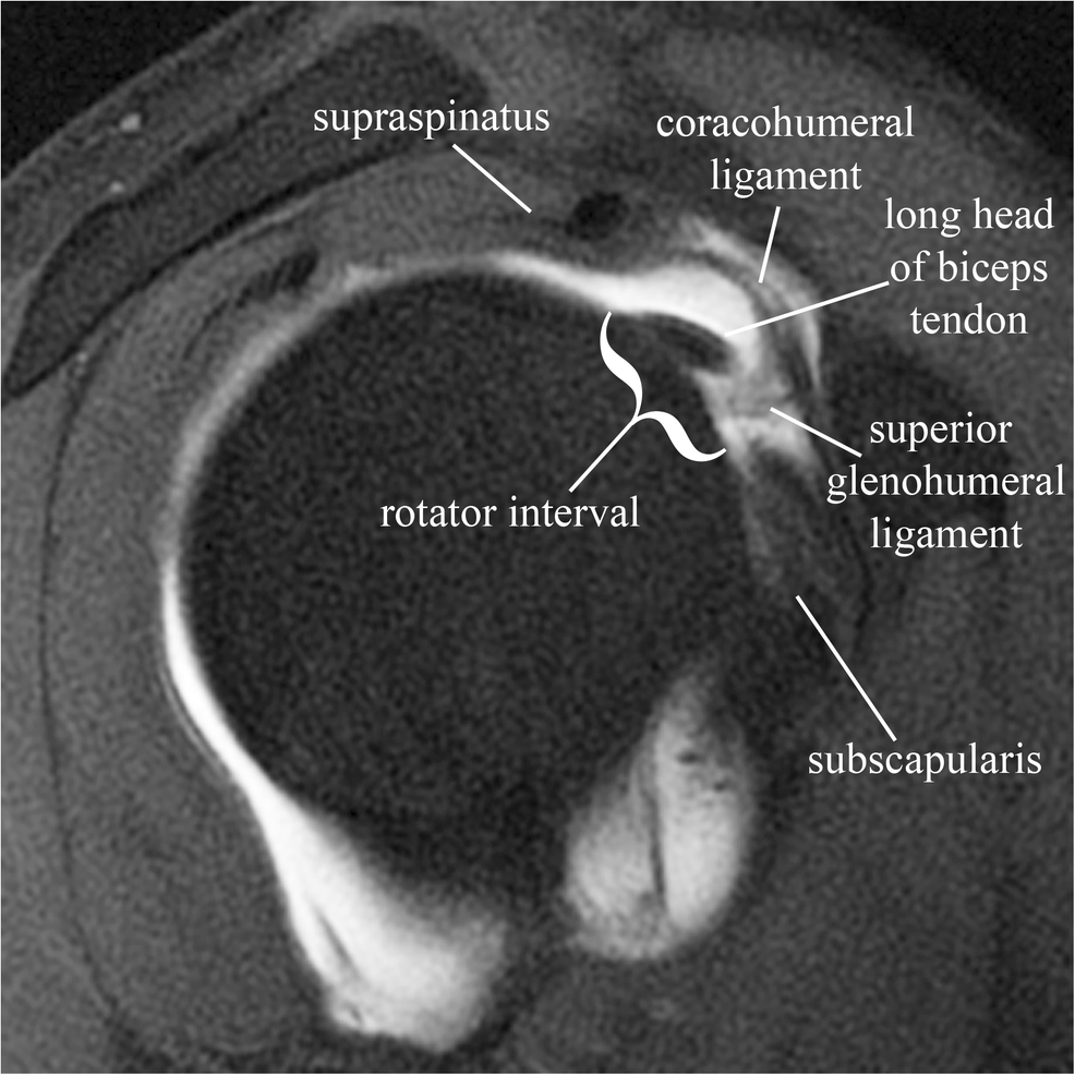 Adhesive capsulitis: review of imaging findings, pathophysiology ...