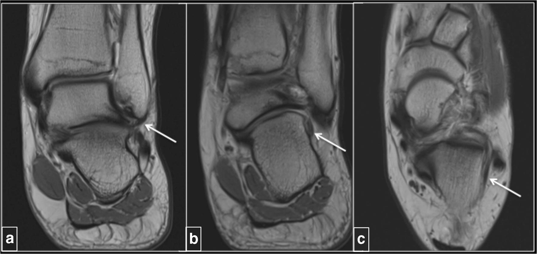 Professional player with an in-game ankle injury | SpringerLink