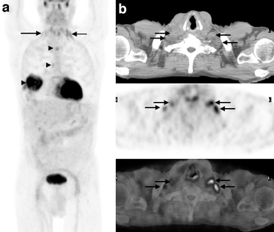 Scalene muscle uptake: a potential pitfall in head and neck PET/CT ...