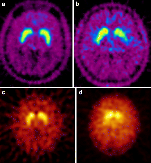Direct comparison of FP-CIT SPECT and F-DOPA PET in patients with ...