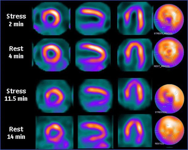 A fast cardiac gamma camera with dynamic SPECT capabilities: design ...