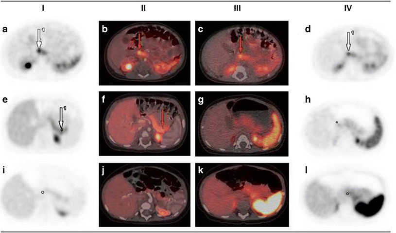 18F-DOPA PET/CT and 68Ga-DOTANOC PET/CT scans as diagnostic tools in ...