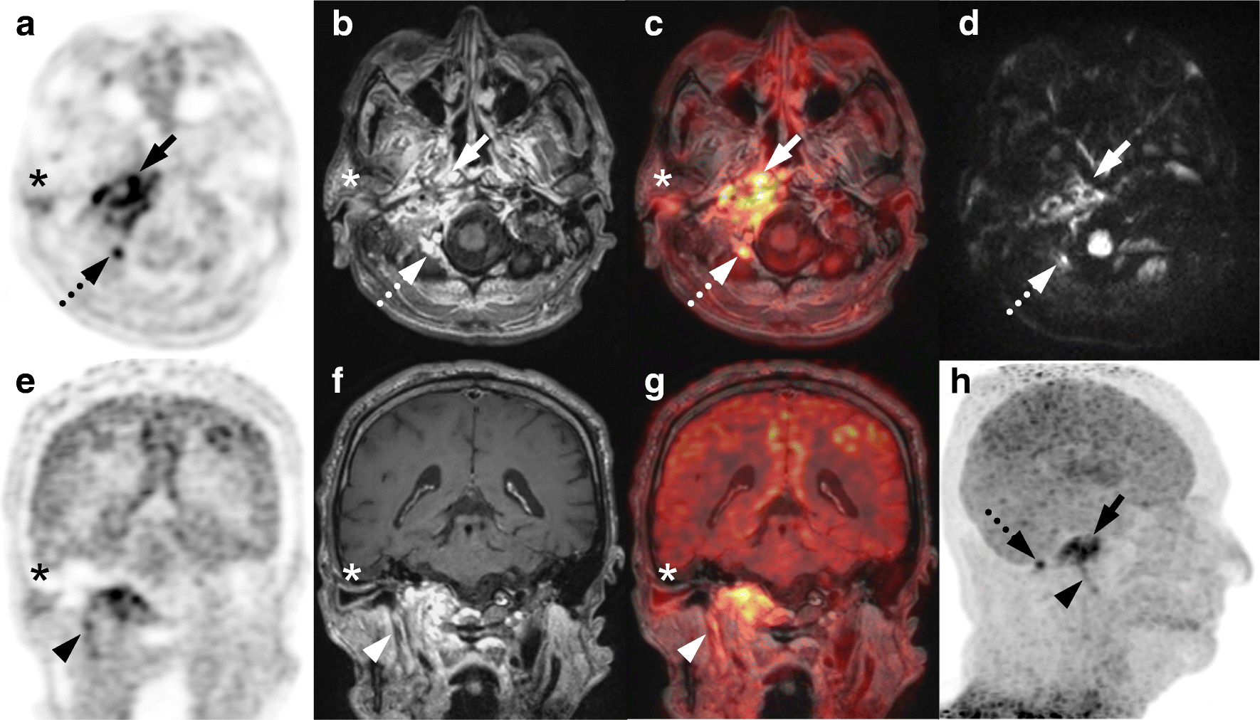 A rare presentation of skull-base osteomyelitis with neurovascular ...