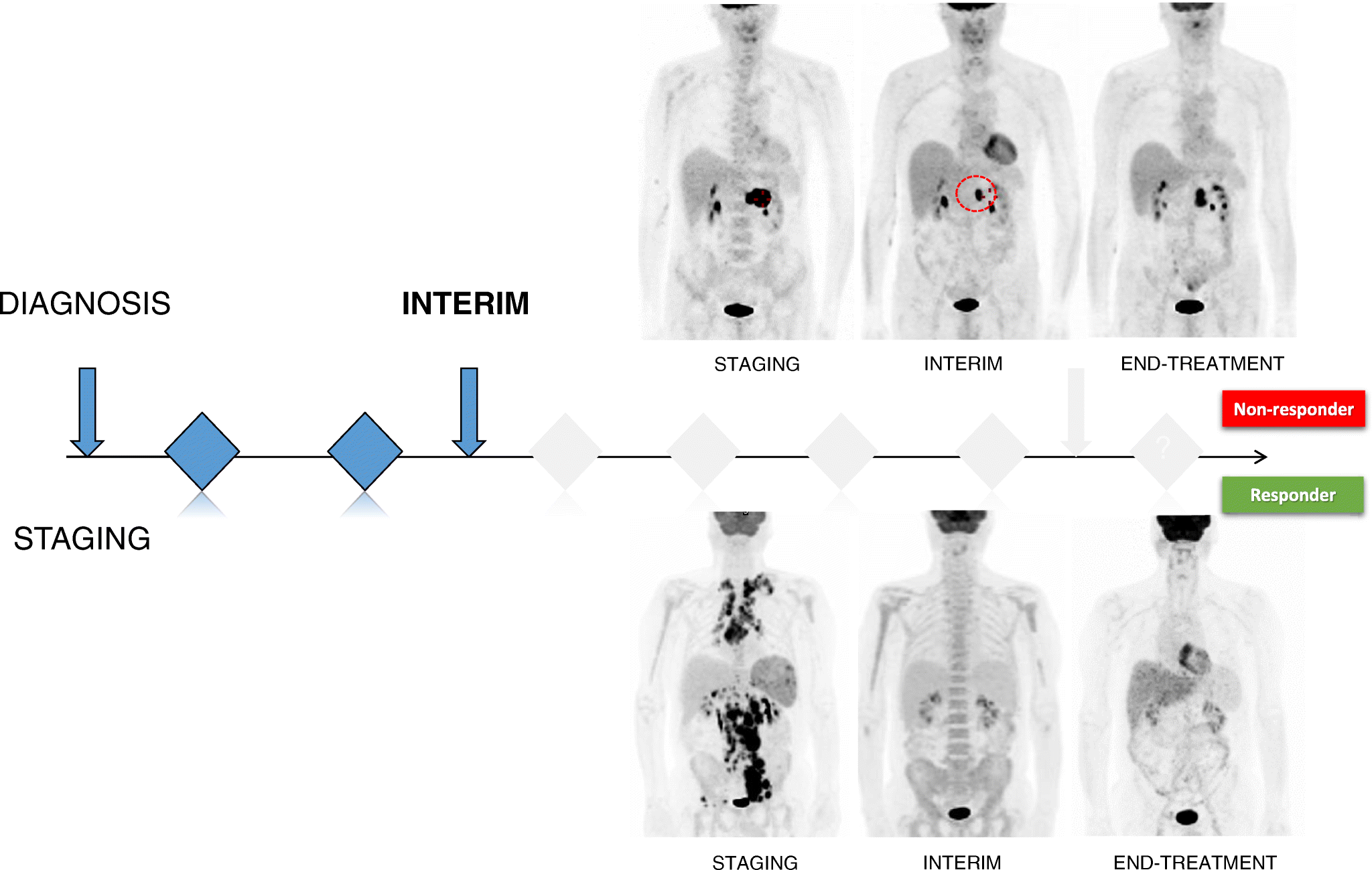 Deauville score: the Phoenix rising from ashes | SpringerLink