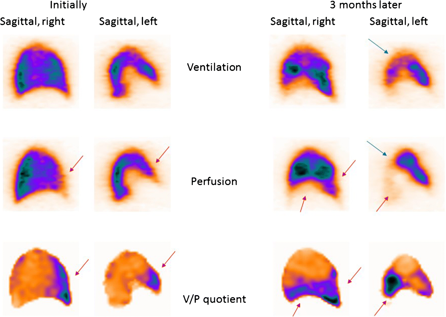EANM guideline for ventilation/perfusion single-photon emission ...