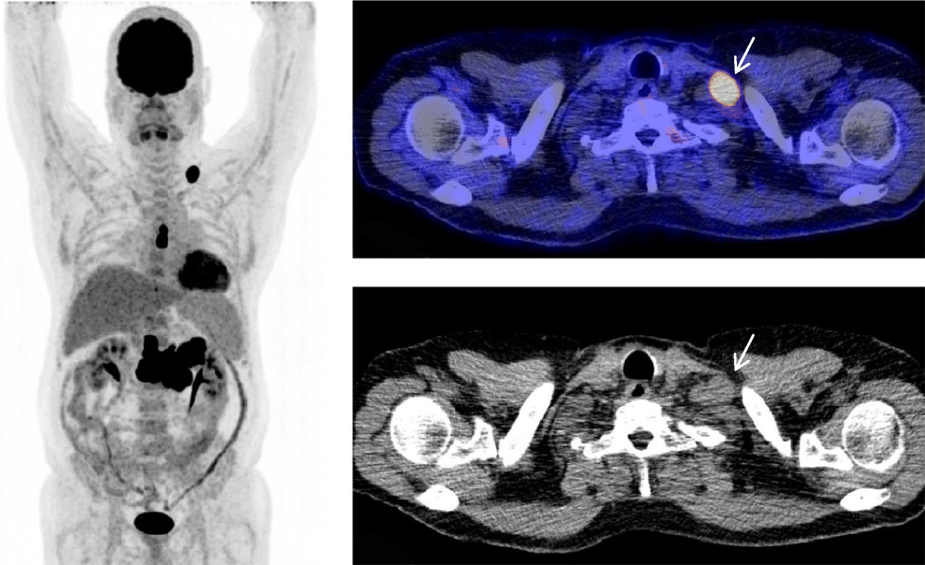 Diagnostic performance of FDG-PET/CT of post-transplant ...