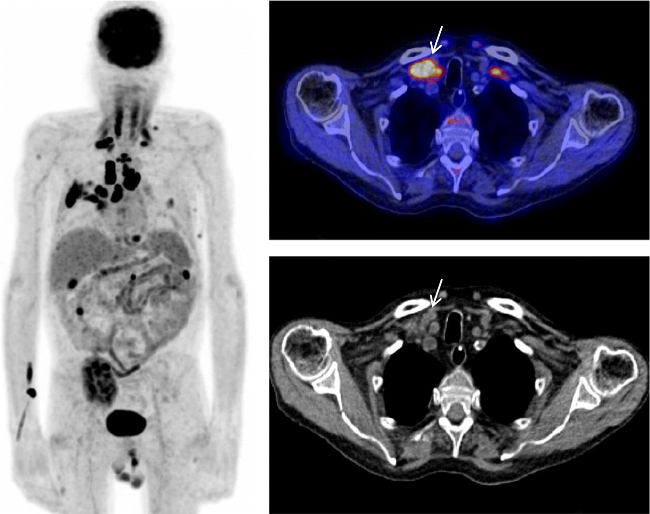 Diagnostic performance of FDG-PET/CT of post-transplant ...