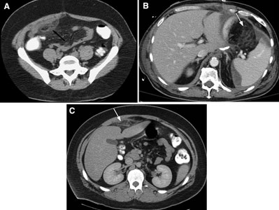Omental infarct: CT imaging features | SpringerLink