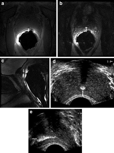 Hematospermia: imaging findings | SpringerLink