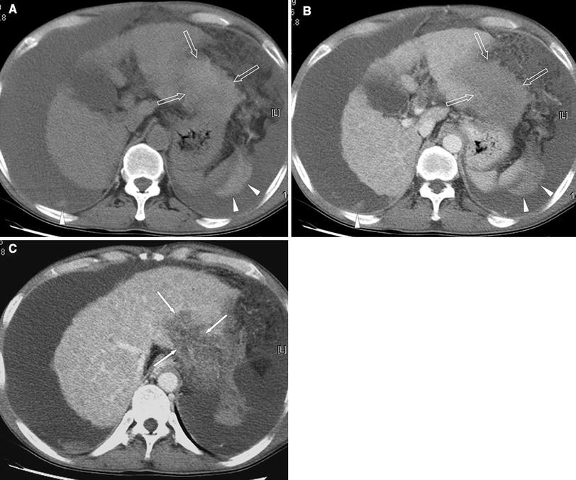 The various manifestations of ruptured hepatocellular carcinoma: CT ...