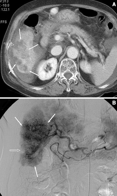 The various manifestations of ruptured hepatocellular carcinoma: CT ...