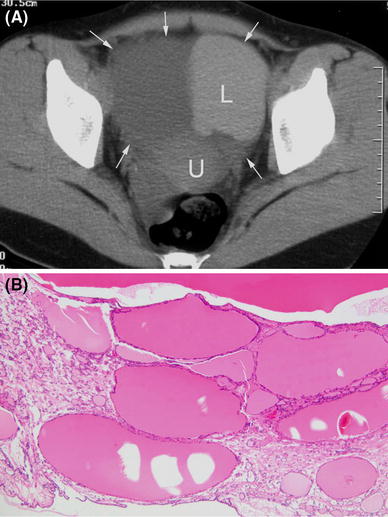 Struma ovarii: CT findings | SpringerLink
