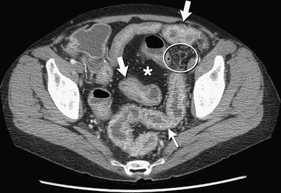 CT enterography of Crohn’s disease | SpringerLink