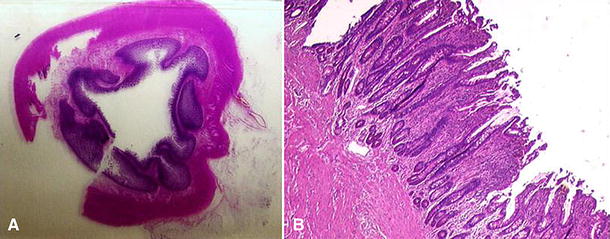 Intestinal duplication in an adult patient diagnosed by multidetector ...
