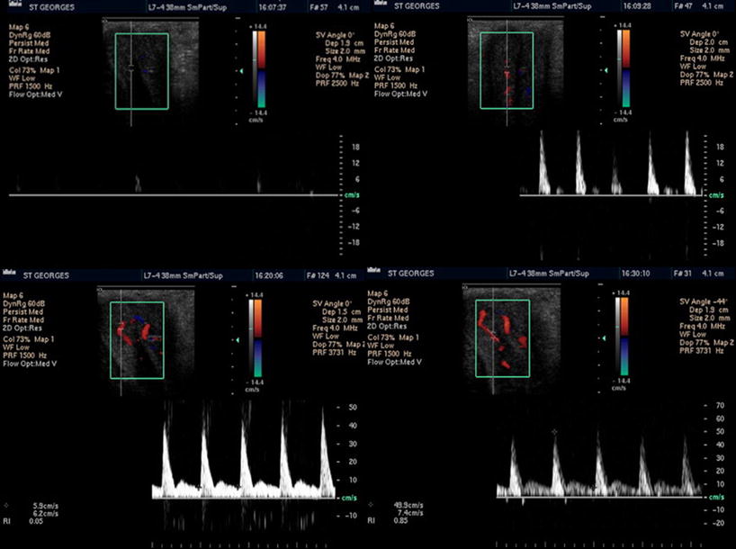 Erectile dysfunction: the role of penile Doppler ultrasound in ...