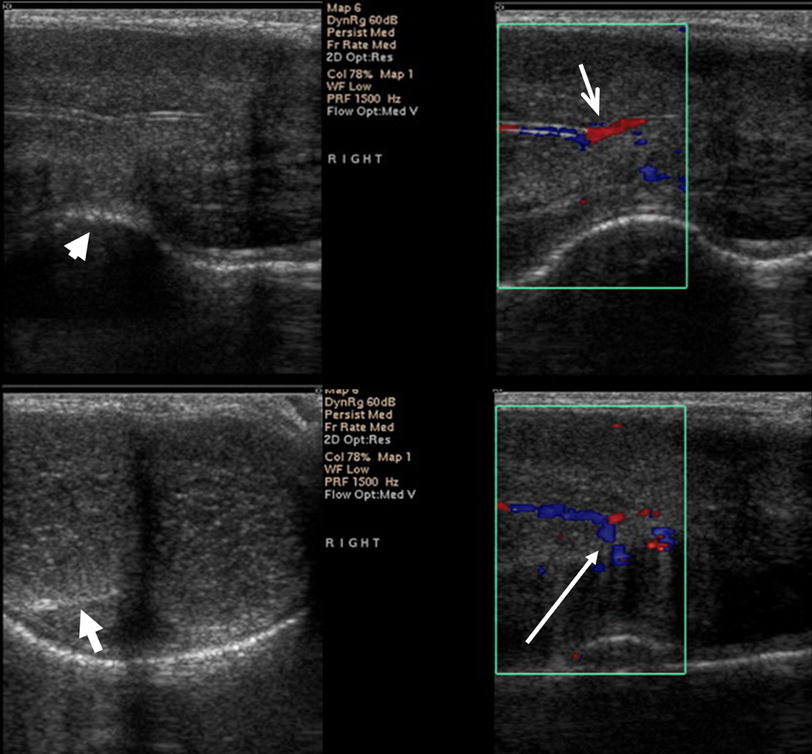 Erectile dysfunction: the role of penile Doppler ultrasound in ...