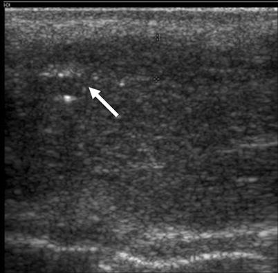 Erectile dysfunction: the role of penile Doppler ultrasound in ...