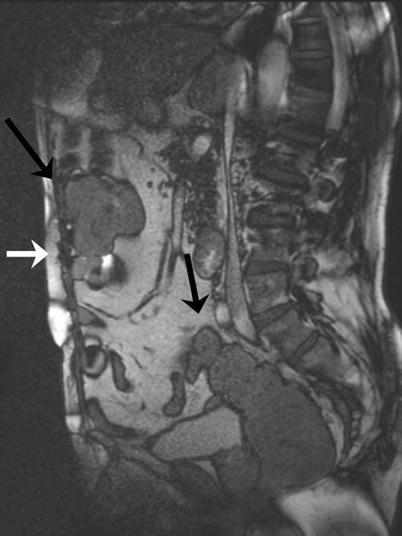Detection of recurrent hernia and intraabdominal adhesions following ...