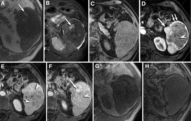 Sclerosing angiomatoid nodular transformation of the spleen: CT, MR ...
