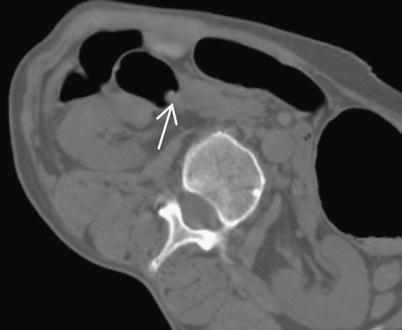 CT virtual endoscopy of the ampulla of Vater: preliminary report ...