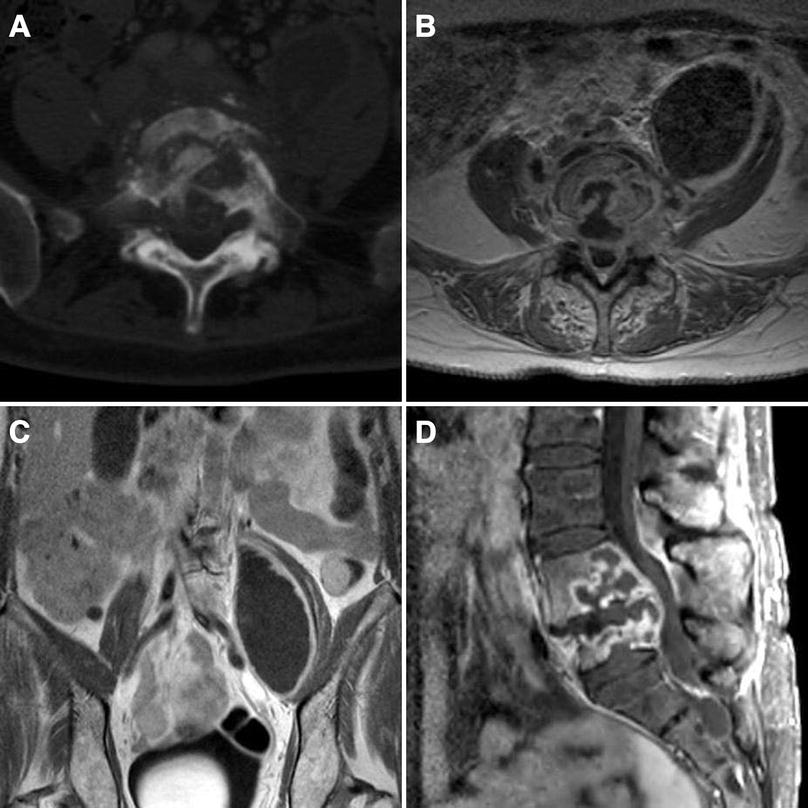 Common and unusual diseases involving the iliopsoas muscle compartment ...