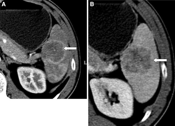Sclerosing angiomatoid nodular transformation of the spleen (SANT ...