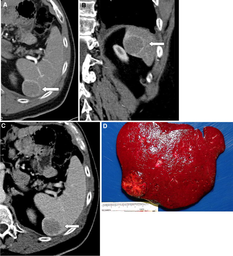 Sclerosing angiomatoid nodular transformation of the spleen (SANT ...