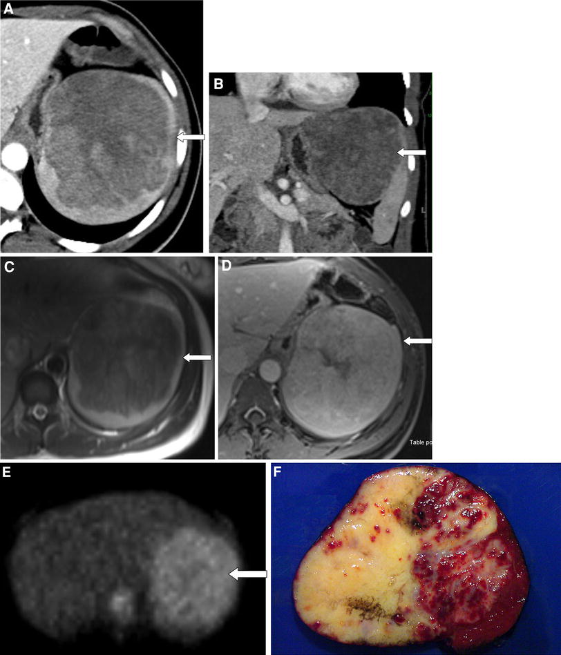 Sclerosing angiomatoid nodular transformation of the spleen (SANT ...