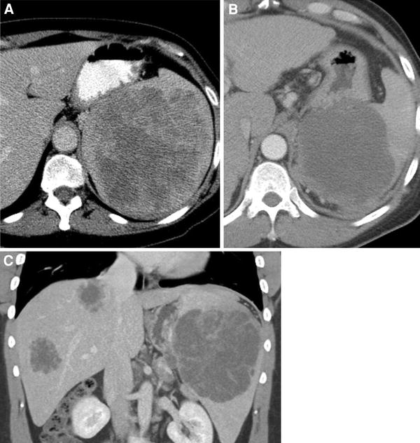Sclerosing angiomatoid nodular transformation of the spleen (SANT ...