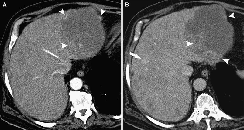 Hepatic angiosarcoma: cross-sectional imaging findings in seven ...
