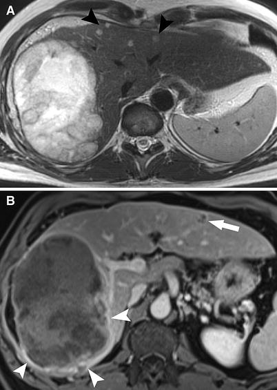 Hepatic angiosarcoma: cross-sectional imaging findings in seven ...