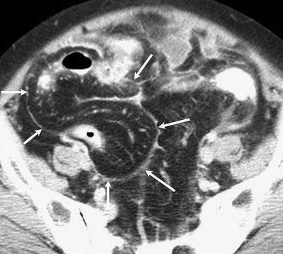 The most characteristic lesions and radiologic signs of Crohn disease ...
