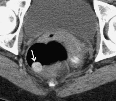Benign and malignant tumors of the rectum and perirectal region ...