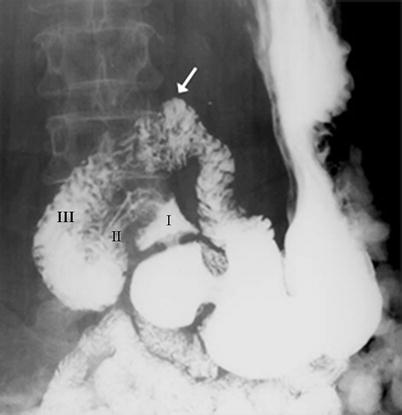 Multimodality imaging of diseases of the duodenum | SpringerLink