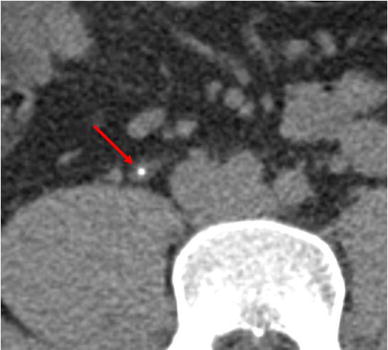 Soft-tissue rim sign | SpringerLink