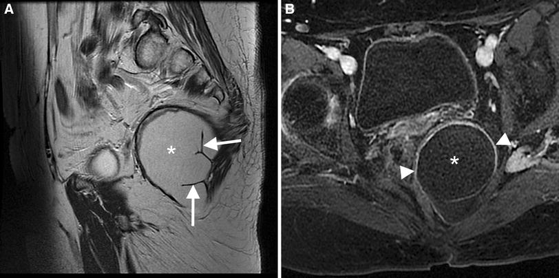 MR imaging of the retrorectal–presacral tumors: an algorithmic approach ...