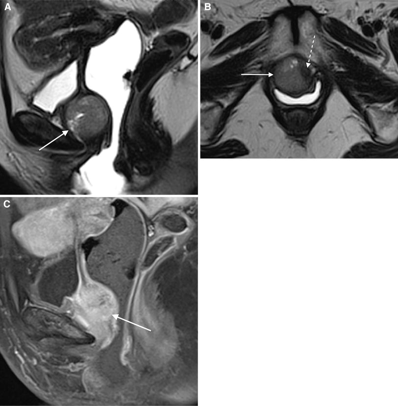 Female perineal diseases: spectrum of imaging findings | SpringerLink