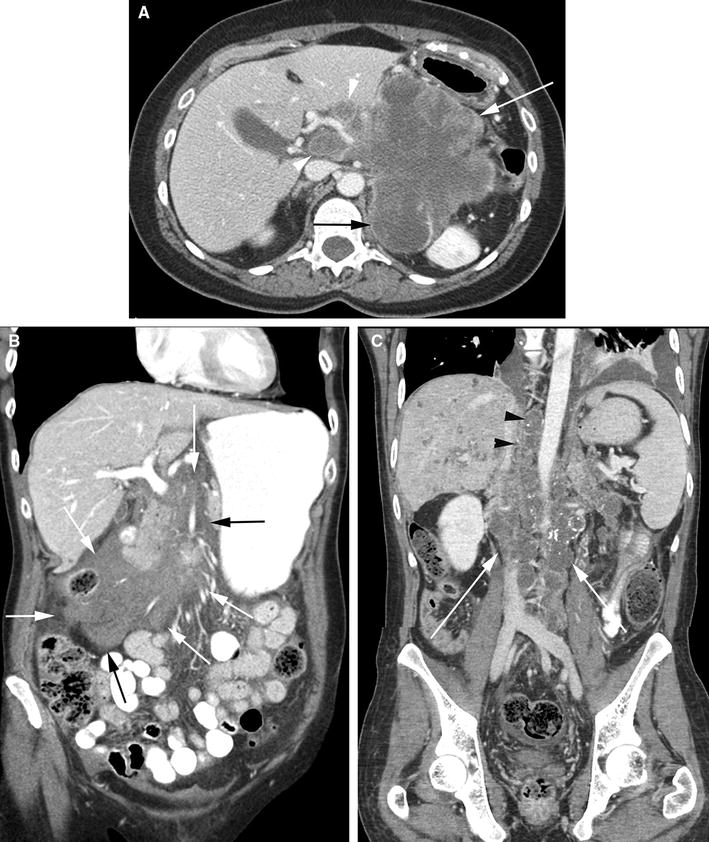 The subperitoneal space and peritoneal cavity: basic concepts ...